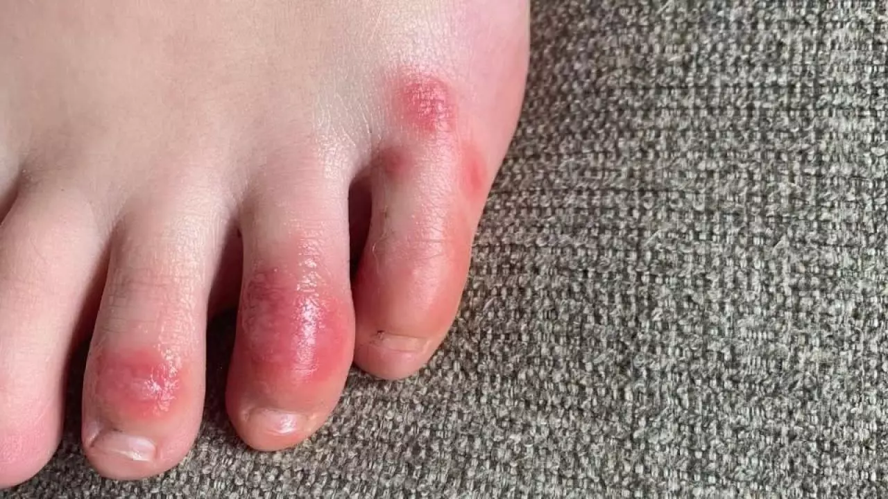 Dermatologii raportează simptome ciudate ale degetelor de la picioare potențial legate de Covid-19