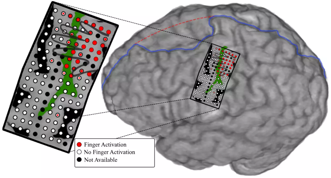 Implant mózgu pozwoli osobom po amputacji poruszać pojedynczymi palcami na protezach za pomocą samych myśli