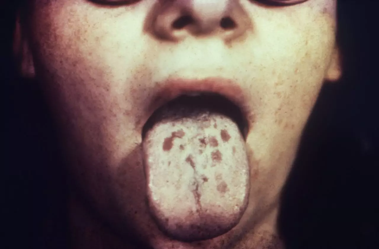 Fotografía de una persona con manchas mucosas en la lengua causadas por sífilis secundaria.