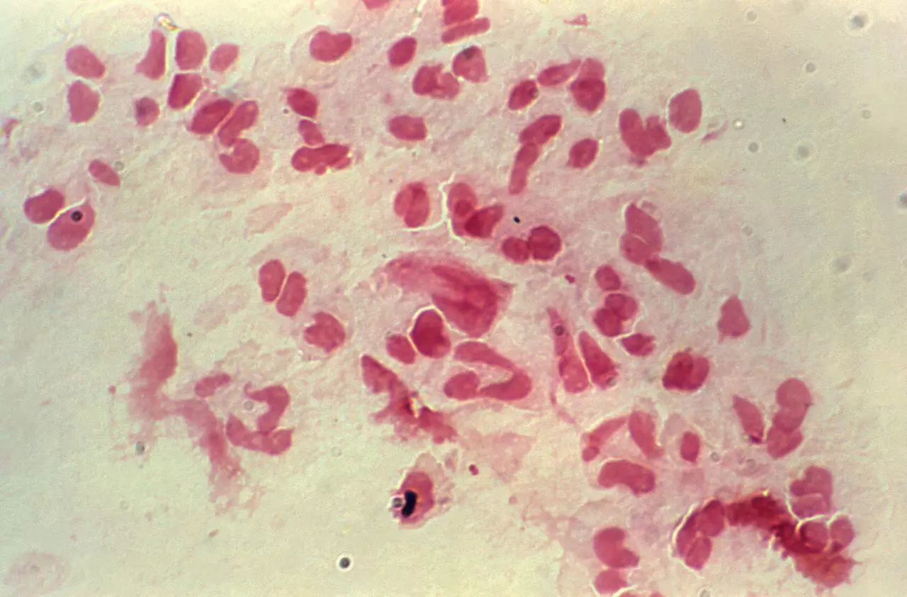 Gonoreli birinden mikroskop altında bir genital akıntı örneği görünüyor. (Resim: CDC/Joe Miller)