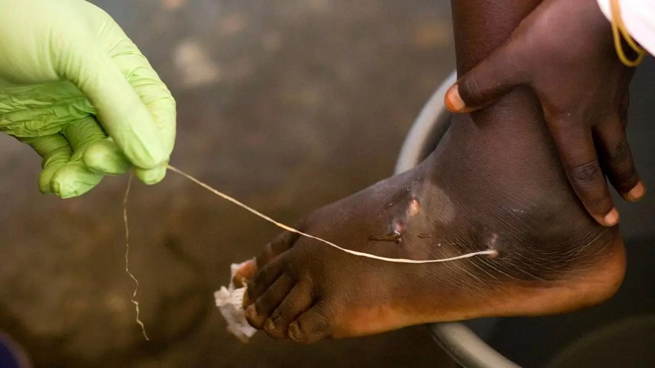 Seekor cacing Guinea diekstrak dari kaki kanak-kanak di pusat pembendungan di Savelugu, Ghana dalam gambar Mac 2007. Cacing yang ditemui dalam kes Vietnam adalah spesies yang berkaitan, mungkin berasal dari reptilia.