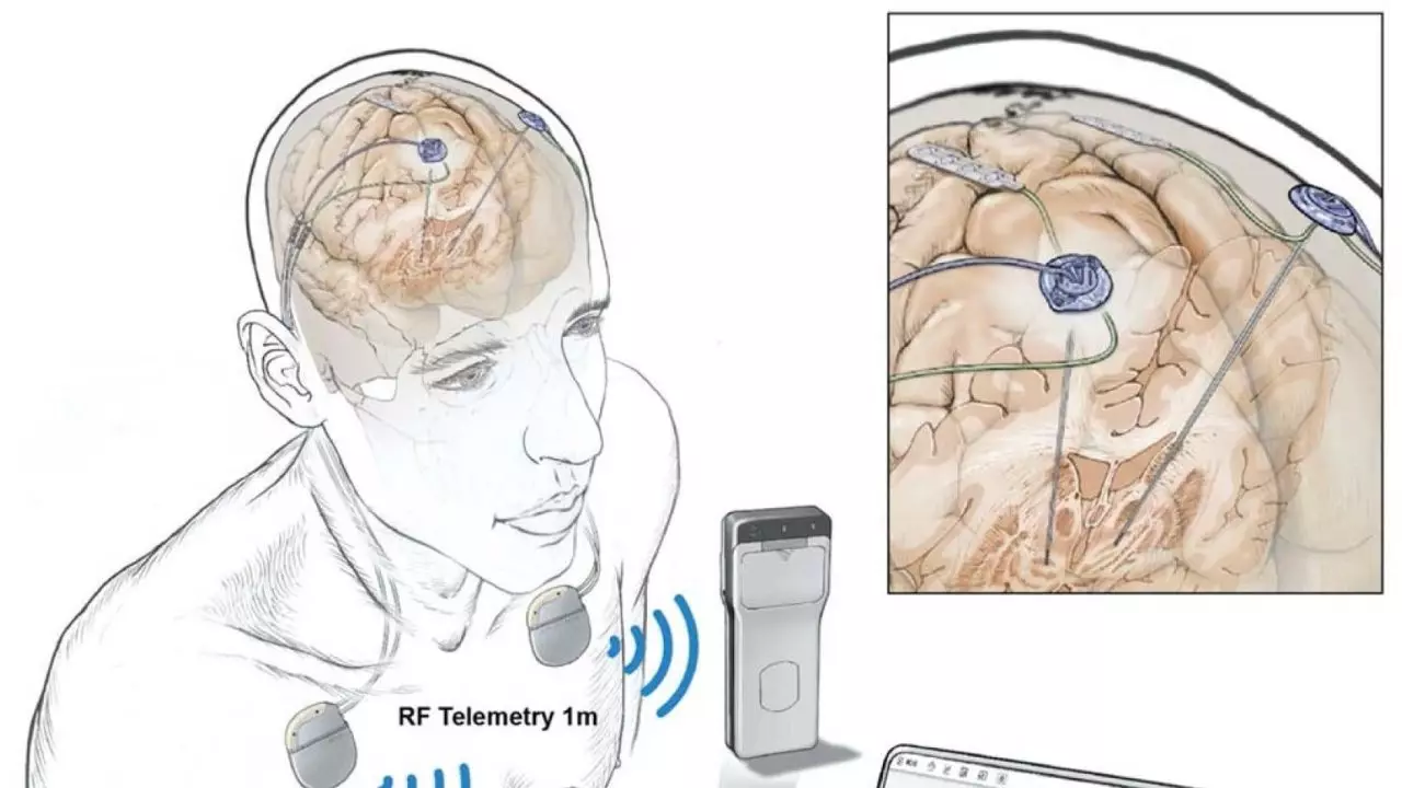 In un primo momento, le persone hanno avuto la loro attività cerebrale monitorata a distanza durante la vita quotidiana
