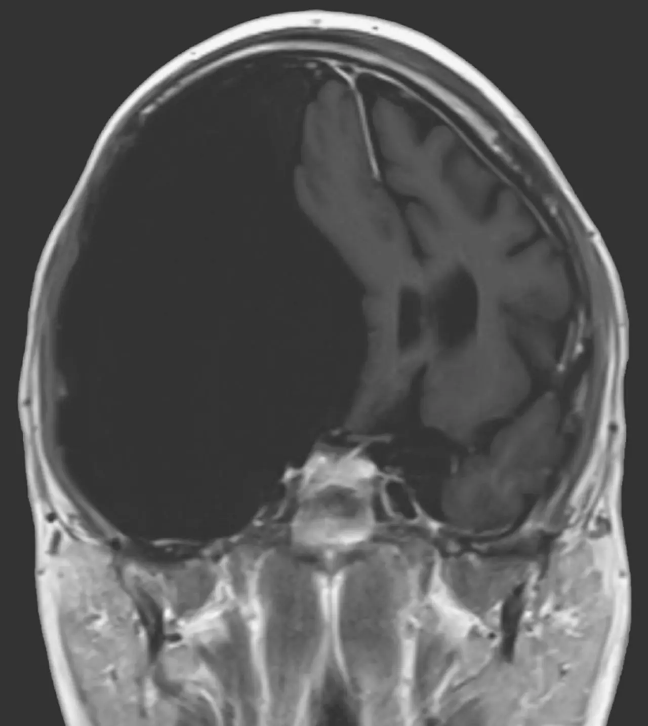 Kista arachnoid Leggett dianggap sebagai salah satu yang terbesar pernah direkodkan oleh doktor. (Imej: Jennifer de Longpre, New England Journal of Medicine)