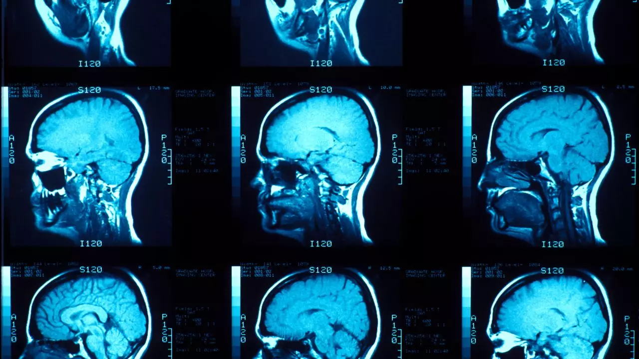 Ilmuwan Semakin Dekat Untuk Menemukan Seperti Apa Kesadaran Di Otak