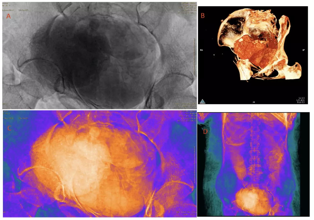 צילומי רנטגן ו-CT של אזור הבטן של המומיה, חושפים את העובר. (תמונה: W. Ejsmond et al., 2021/Journal of Archaeological Science)
