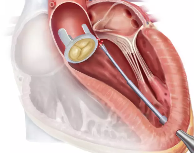Хирурги используют самонавигирующегося робота, чтобы найти негерметичный клапан в свиных сердцах